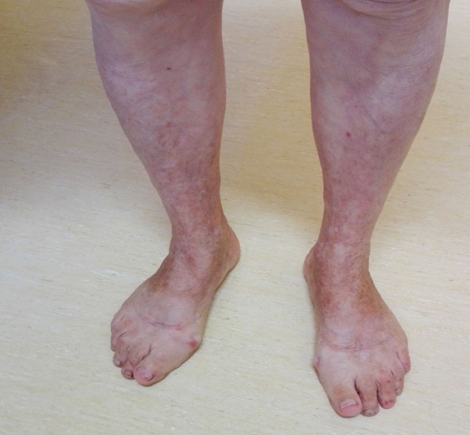 Pigmented Purpuric Dermatosis (PPD) – Dr Marek Sepiolo