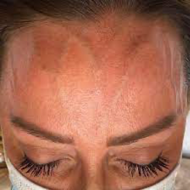 Facial Veins – Dr Marek Sepiolo